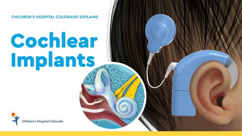 Pediatric Cochlear Implants And Hearing Loss YouTube