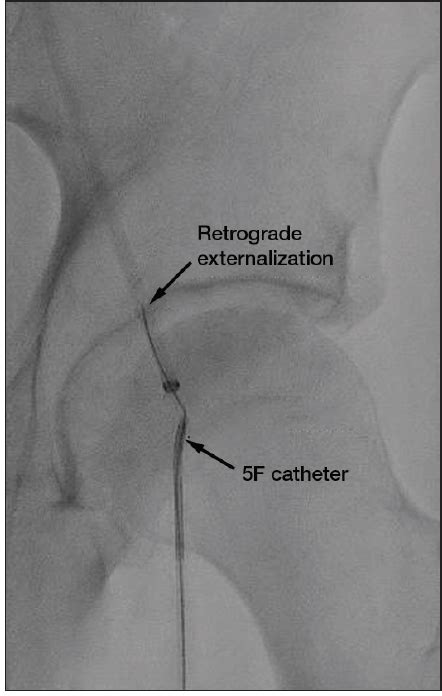 Case Report Retrograde Laser Crossing Of A Left Sfa Occlusion With An Ambiguous Proximal Cap