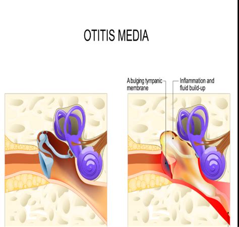 Otitis Media