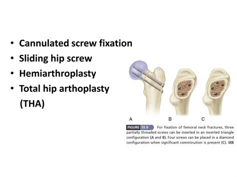 Fractures Around Hip Pptx