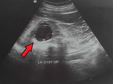 Ultrasound Showing Loss Of Corticomedullary Differentiation And Simple