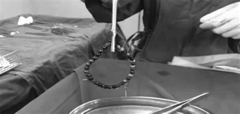 Tot Eats 36 Magnetic Balls Puncturing Intestine