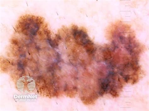 Histoquarterly Superficial Spreading Malignant Melanoma