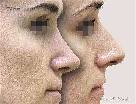 Female Tip Correction The Right Nose