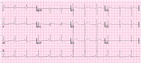 Dyspnea And Convex St Elevation Marked Lvh With Bedside Echos Dr Smiths Ecg Blog