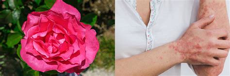 Important Information About Rose Disease