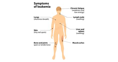 Leukaemia Cancer Symptoms Causes Prevention And Treatments