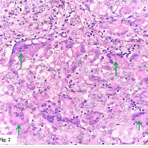 Histiocytic Multinucleated Giant Cells Green Arrows Hematoxylin And Download Scientific