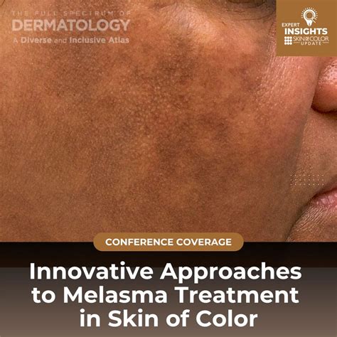 Innovative Approaches To Melasma Treatment In Skin Of Color Next