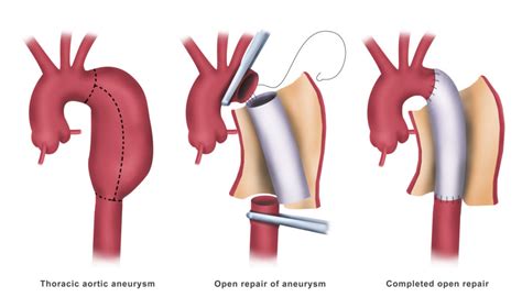 Ascending Aortic Aneurysm Surgery Success Rate Pregna Vrogue Co