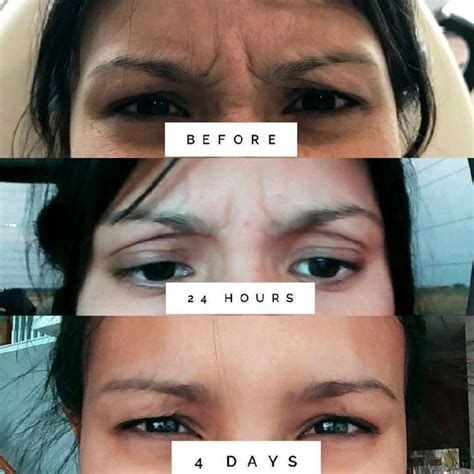 Botox 11 Lines Before 24 Hours And 4 Days After Facial Injections