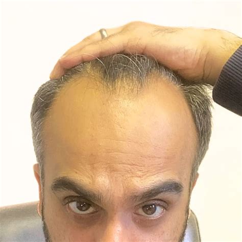 Post Chemotherapy Hair Loss Recovery Treatment From Hhc