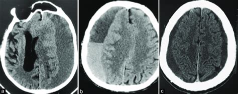 Axial Cuts Of Cranial Computed Tomography Scans Showing Different