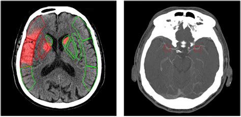 Cat Scan Brain Stroke