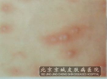 带状疱疹发病症状 带状疱疹 北京京城皮肤医院 北京医保定点机构