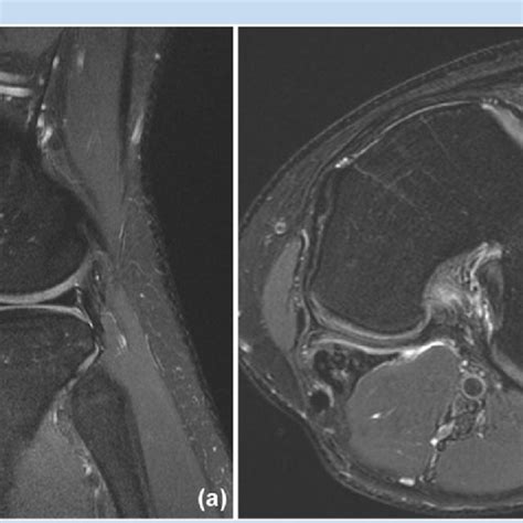 A Sagittal And B Axial Mri Of Chondral Defect Measuring 11 × 10 Mm