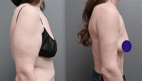 Brachioplasty Ram Plastic Surgery