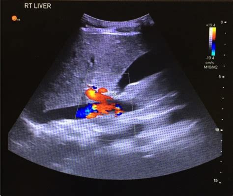 Classical Presentation Of Acute Appendicitis In The Case Of A Subhepatic Appendix Pmc