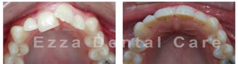 Misaligned Teeth Causes Effects And Treatment Options Ezza Dental Care