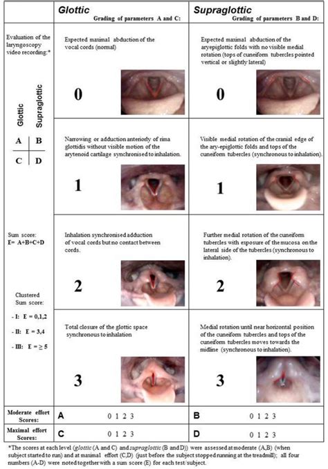 Grading System Of Laryngeal Obstruction According To Maat Et Al 13