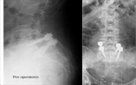 Post Operative X Ray Download Scientific Diagram
