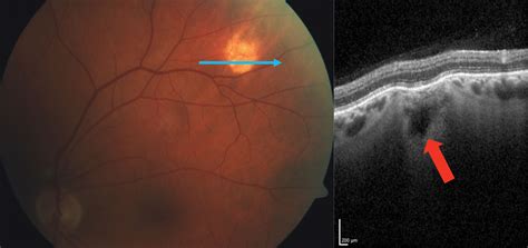 Ct Of Scleral Plaques