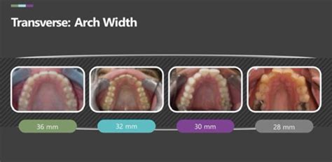 Maxillary Skeletal Expansion Mse Dentist Arlington Va