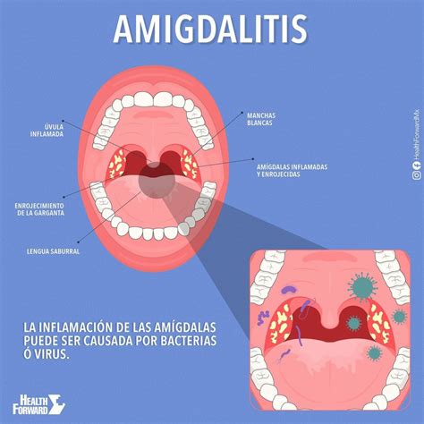 La Amigdalitis Es Una Inflamación Portal Odontólogos