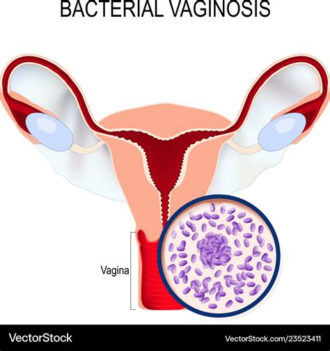 Gardnerella Vector Images 31