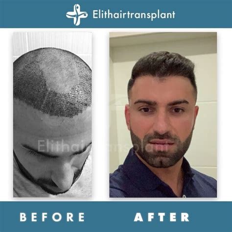 Elithairtransplant Kosten Und Vorher Nacher Mit Negative Erfahrungen