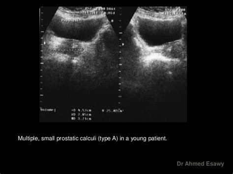Imaging Prostatitis Urethritis Dr Ahmed Esawy