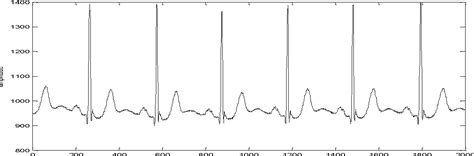Figure 1 From Detection Of Qrs Complex In Electrocardiogram Signal By The Empirical Mode