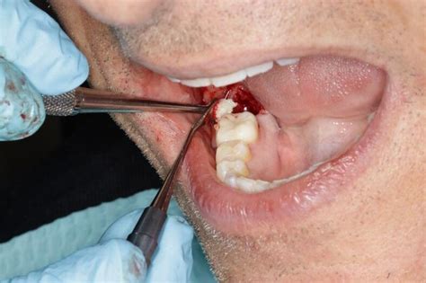 Alveolar Socket Management Biocellgraft
