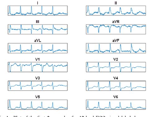 Table I From Detecting Cardiac Abnormalities Using 12 Lead Ecg And Deep