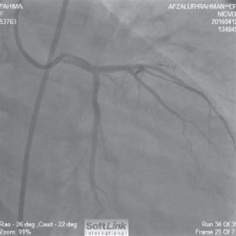 Timi Iii Flow Achieved With Proper Positioning Of The Stent With Full