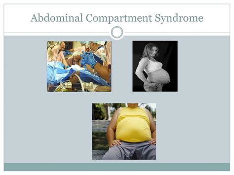 Abdominal Compartment Syndrome Drbeckmann