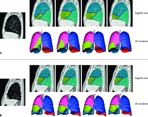 The Sagittal View And 3d Rendering Of The Sample Segmentation Of The Ct Download Scientific