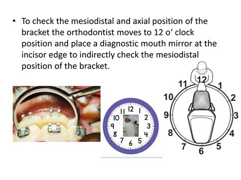 Bracket Gauges And Placement Ppt