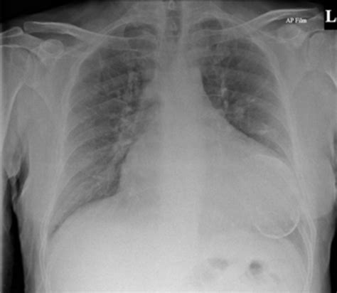 Calcified Left Ventricular Aneurysm “an Egg In The Heart”
