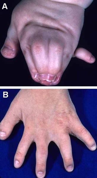 Apert Syndrome Medlineplus Genetics