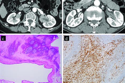 Contrast Enhanced Ct Findings In Patients With Igg4 Related Pyelitis