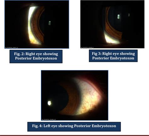 Posterior Embryotoxon Semantic Scholar