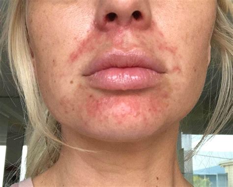 Best Perioral Dermatitis Treatment In Lahore Rated ⭐⭐⭐⭐⭐ Skinfudge