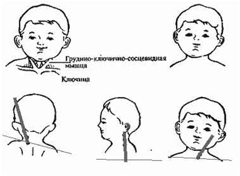 Кривошея у новорожденных: причины и лечение