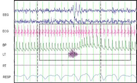 Plms Ma Related Eeg Ecg Beat To Beat Bp And Respiratory Signals Download Scientific Diagram