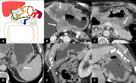 Gastric Adenocarcinoma A Review Of The Tnm Classification System And