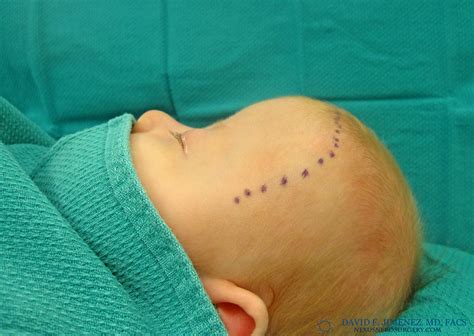 Bicoronal Craniosynostosis