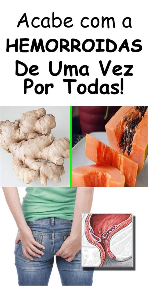 3 Remédios Caseiros Para Tratar As Hemorroidas Rapidamente 10 Things