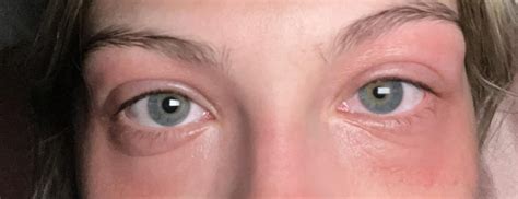 Help Eye Rash R Autoimmune