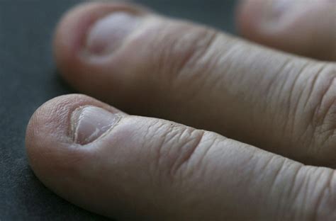 Severely Bitten Nails